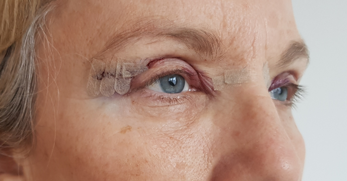 Blepharoplasty recovery guide: Tips for a smooth healing process ...